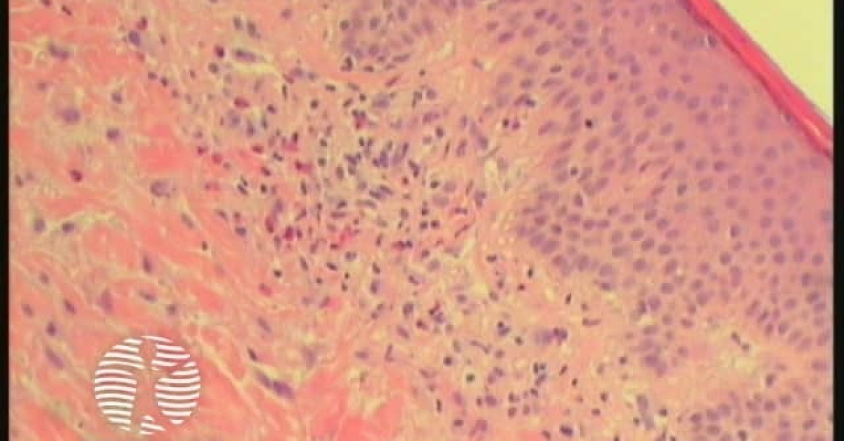 Bullous pemphigoid pathology image