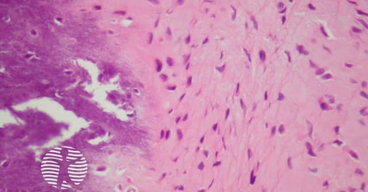Calcifying aponeurotic fibroma pathology image