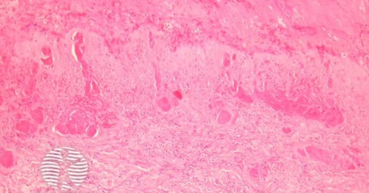 Calciphylaxis pathology image