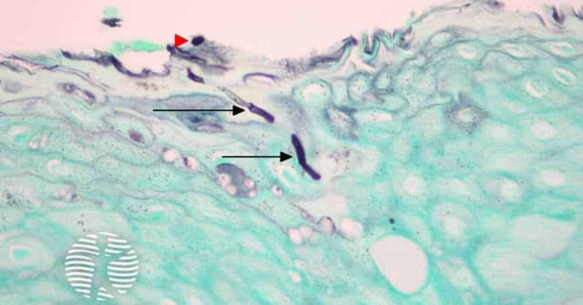 DermNet® - Candidiasis image