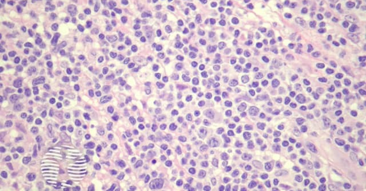 Cutaneous small–medium pleomorphic T-Cell lymphoma pathology image