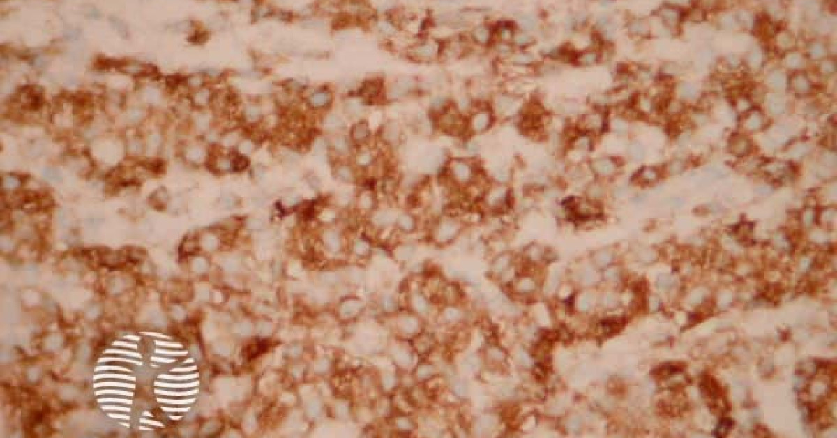 Indolent cutaneous CD8+ lymphoid proliferation pathology image
