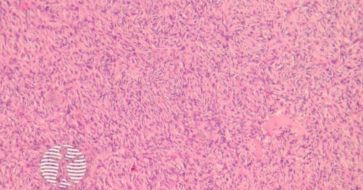 Cellular dermatofibroma pathology image