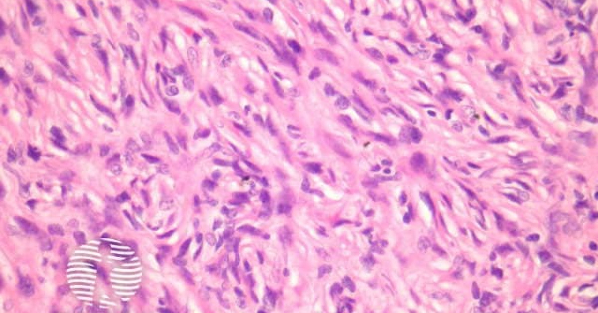 Cellular dermatofibroma pathology image