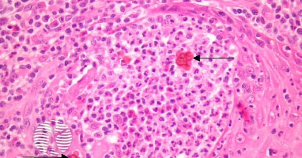 Chromoblastomycosis pathology image