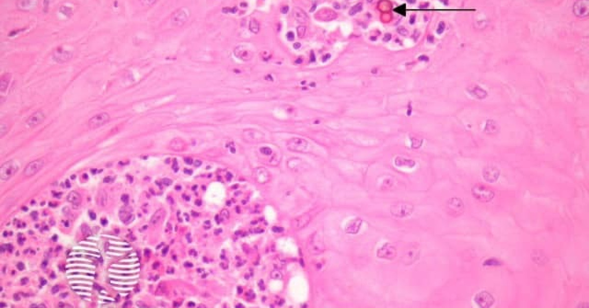Chromoblastomycosis pathology image
