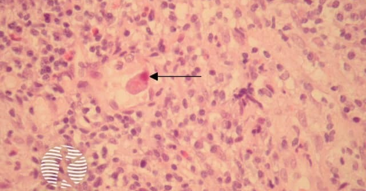 Cytomegalovirus infection pathology image