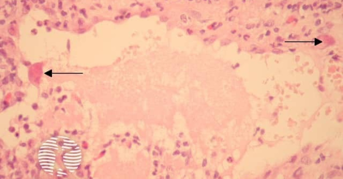 Cytomegalovirus infection pathology image