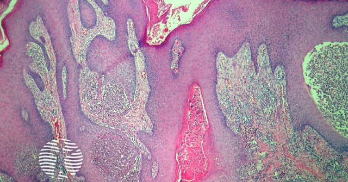 Coccidioidomycosis pathology image