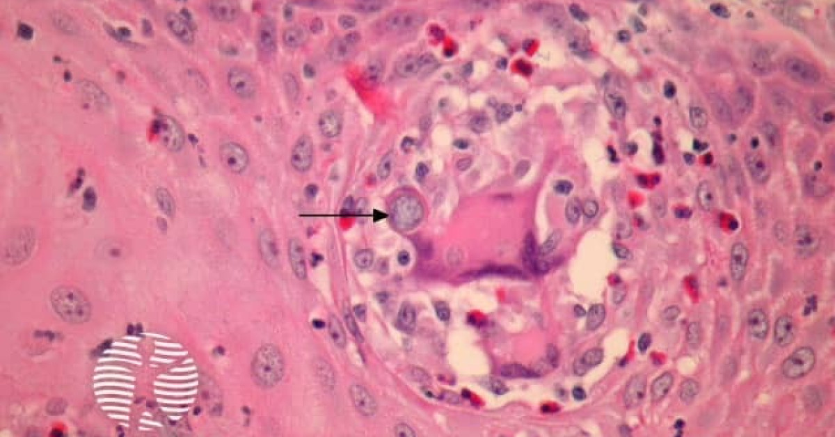 Coccidioidomycosis pathology image