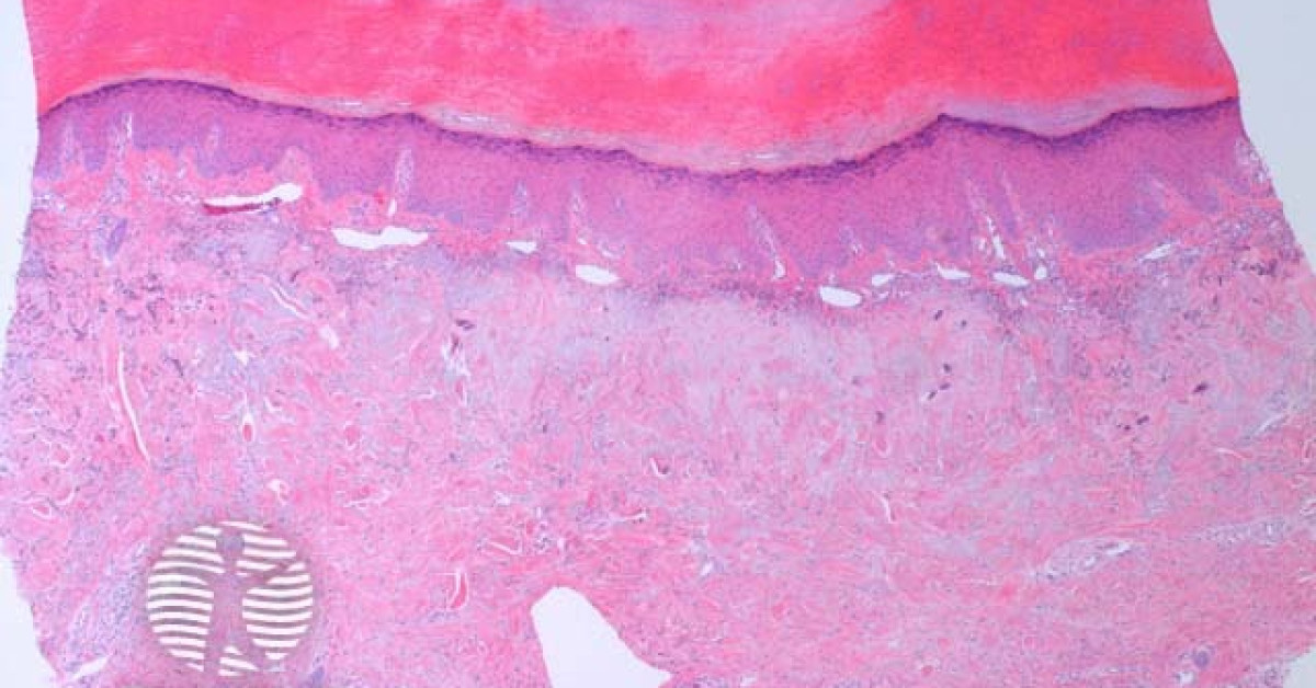 Collagenous and elastotic marginal plaques of the hands (CEMPH ...