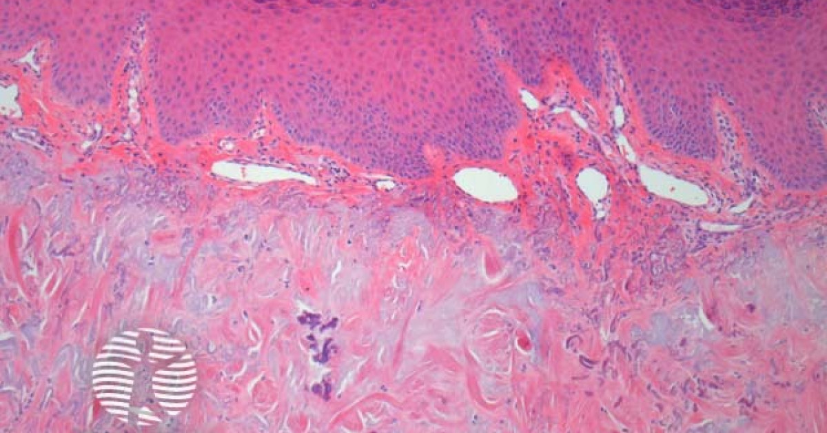 Collagenous and elastotic marginal plaques of the hands (CEMPH ...