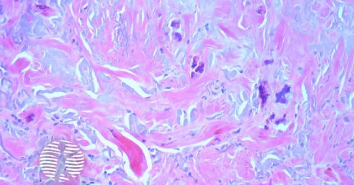 Collagenous and elastotic marginal plaques of the hands (CEMPH ...