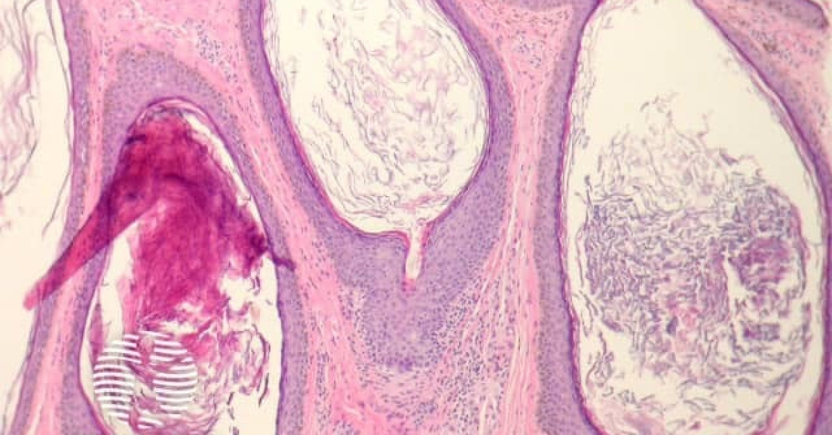 Comedonal cyst pathology image