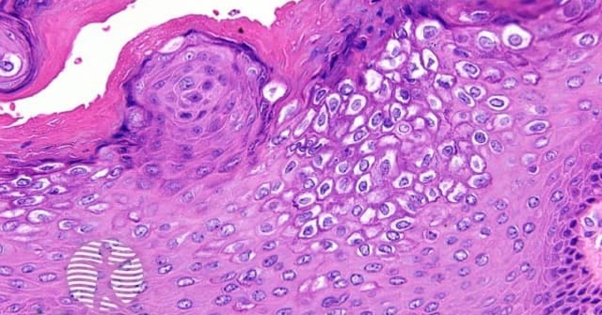 Condyloma acuminatum pathology image