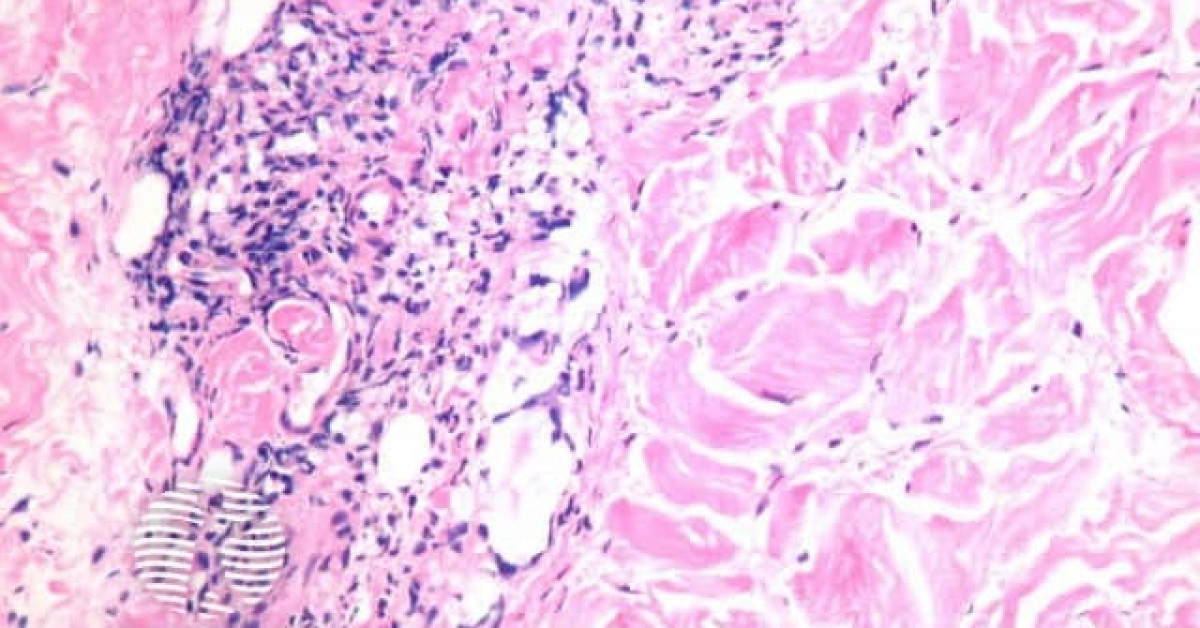 Cryptococcosis pathology image