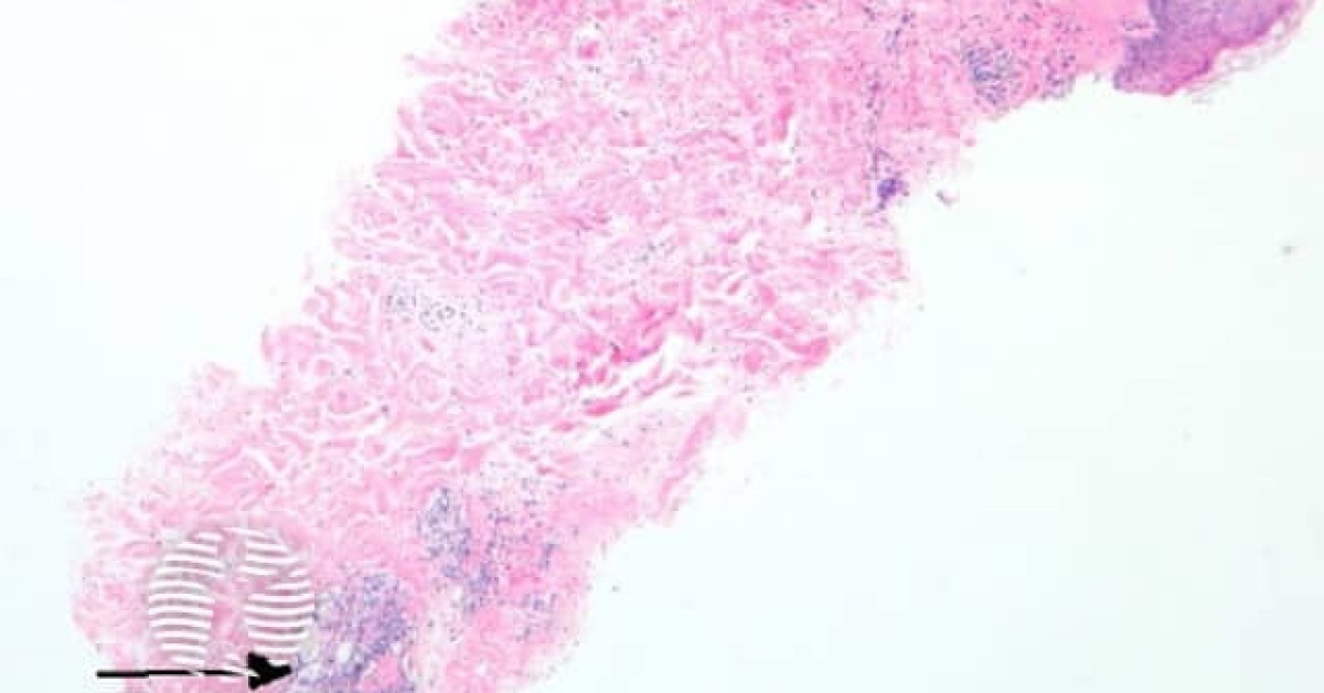 Cryptococcosis pathology image