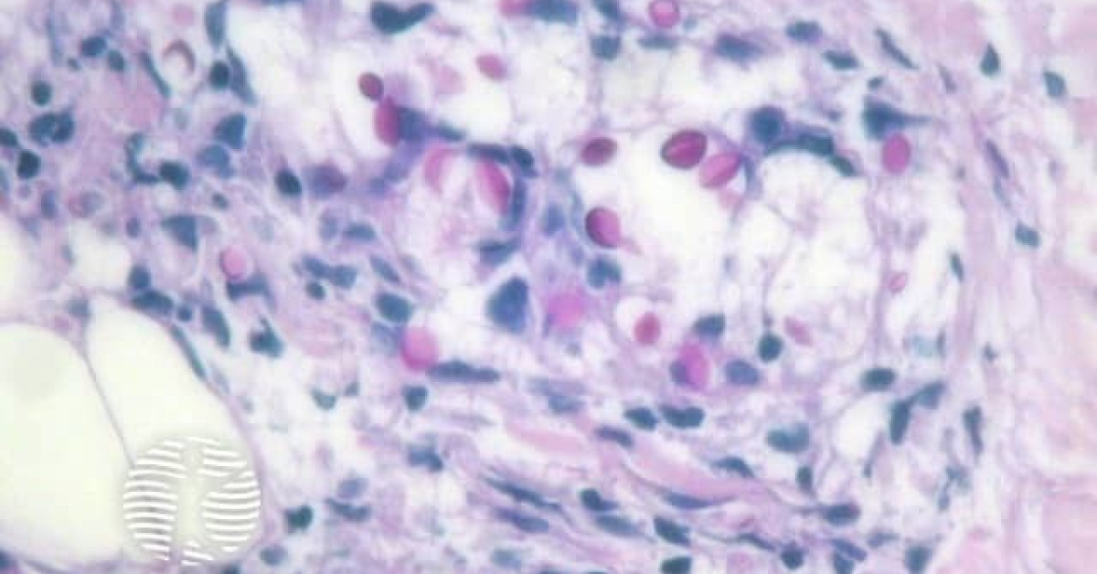 Cryptococcosis pathology image
