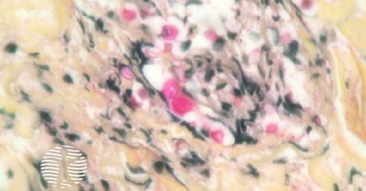 Cryptococcosis pathology image