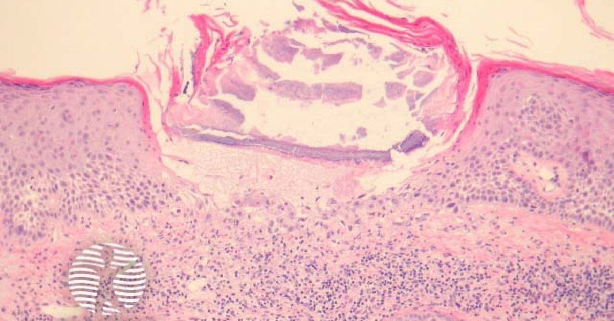 Necrotising infundibular crystalline folliculitis pathology image