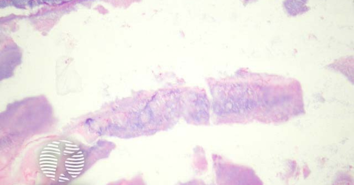 Necrotising infundibular crystalline folliculitis pathology image