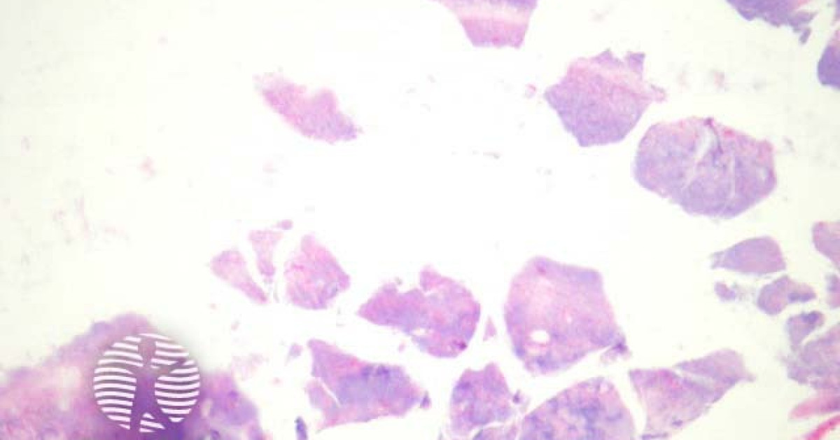 Necrotising infundibular crystalline folliculitis pathology image