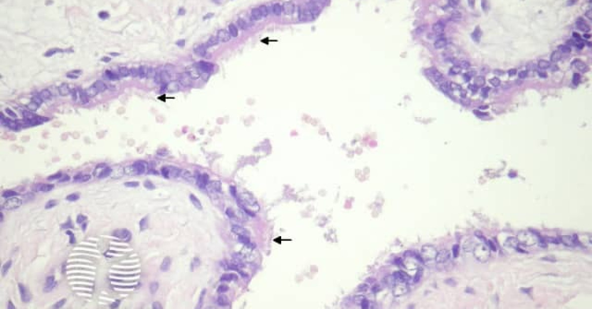 Cutaneous ciliated cyst pathology image