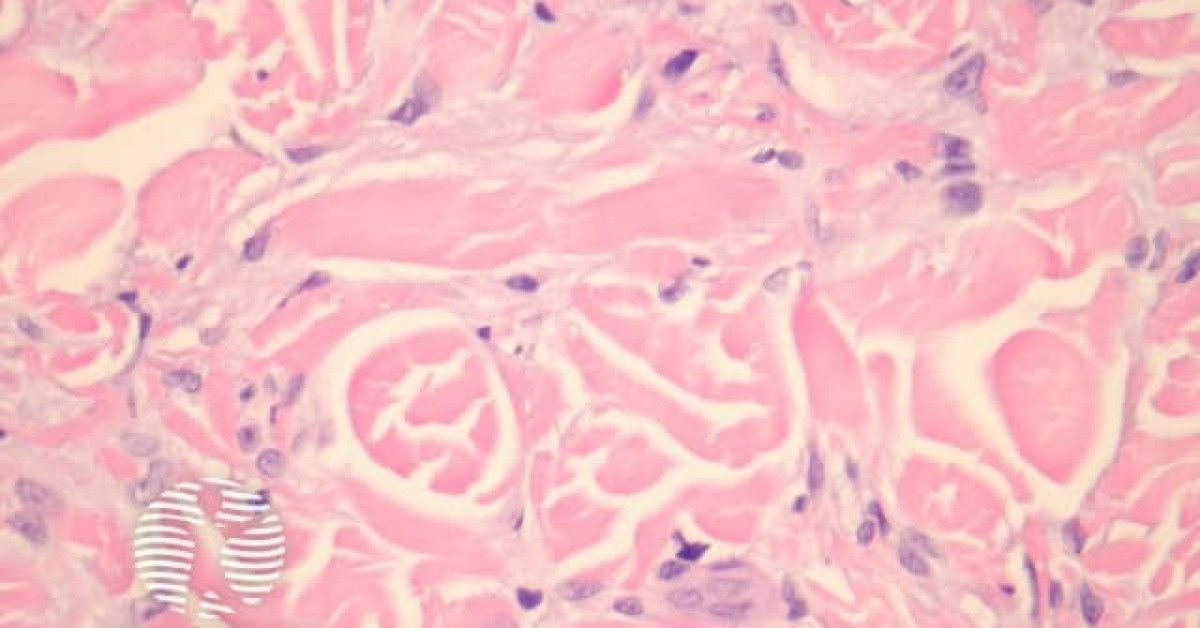 Dermatofibroma pathology image