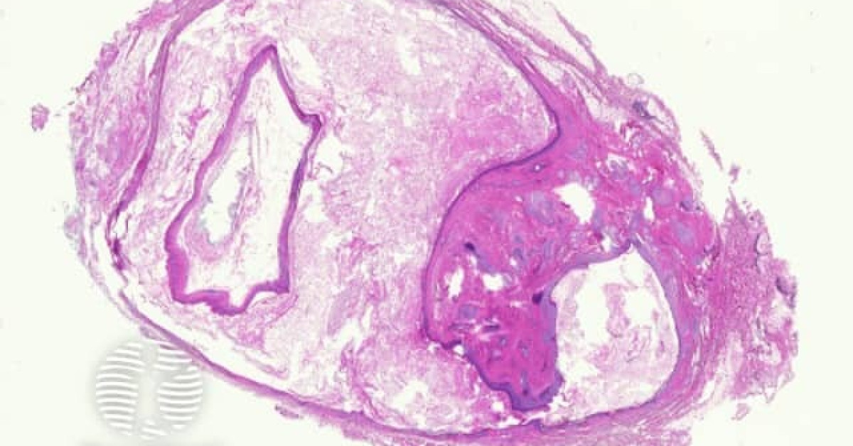 Dermoid cyst pathology image