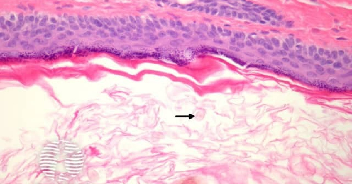Dermoid Cyst Pathology Image