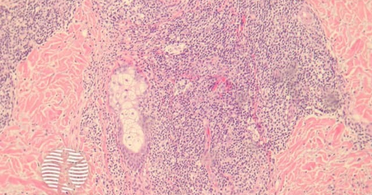 Pathology of discoid lupus erythematosus image