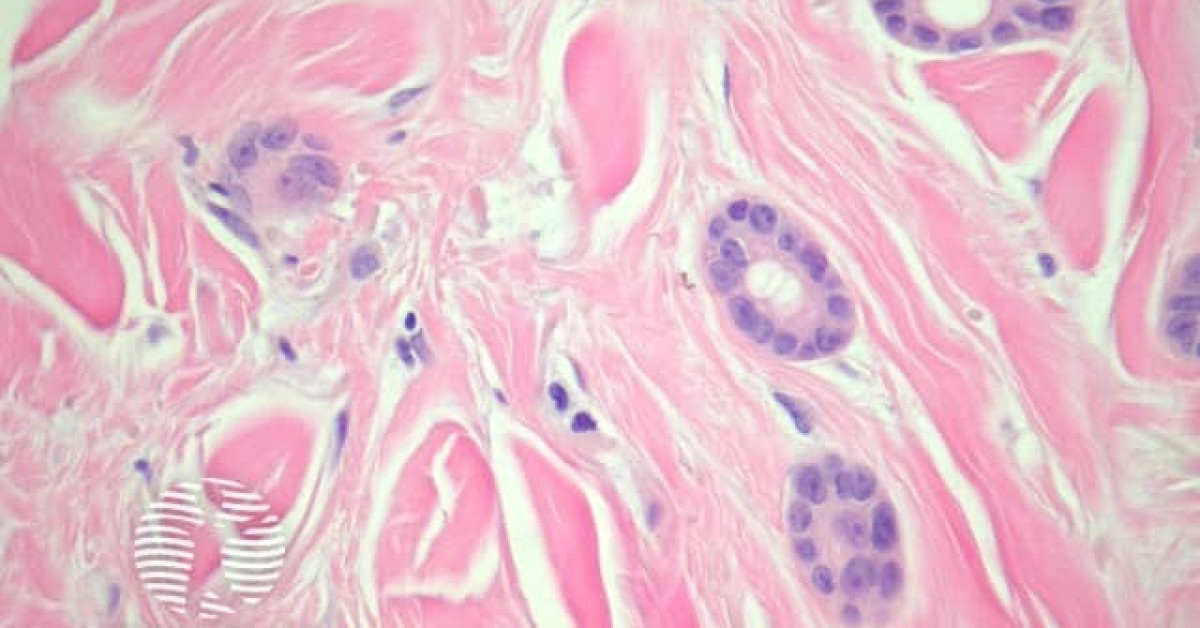 Eccrine carcinoma pathology image