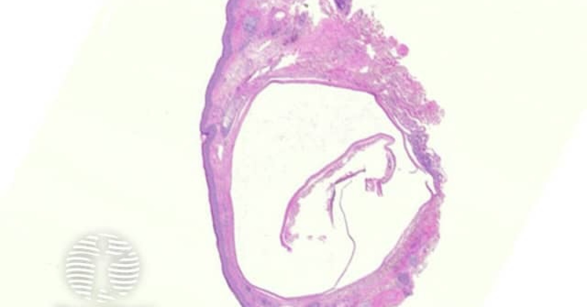 Eccrine hidrocystoma pathology image