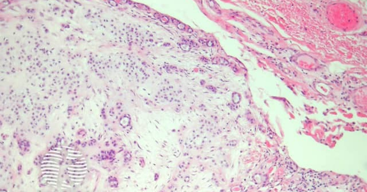 Eccrine mixed tumour pathology image