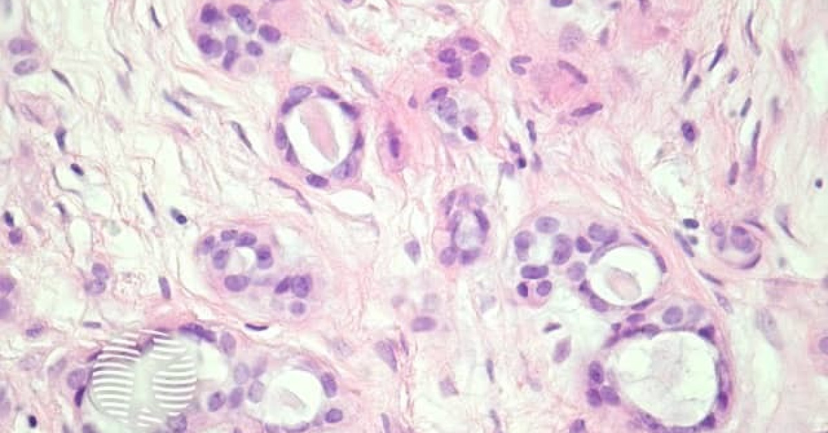 Eccrine mixed tumour pathology image