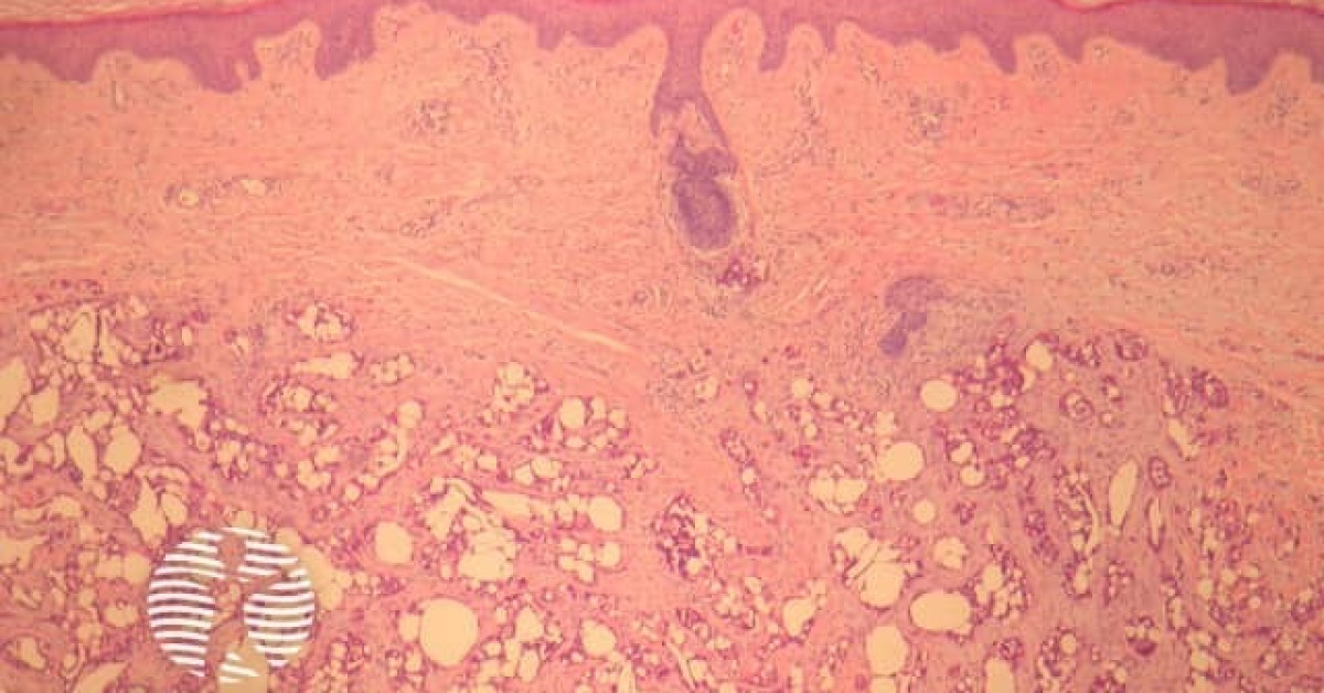 Eccrine papillary adenoma pathology image