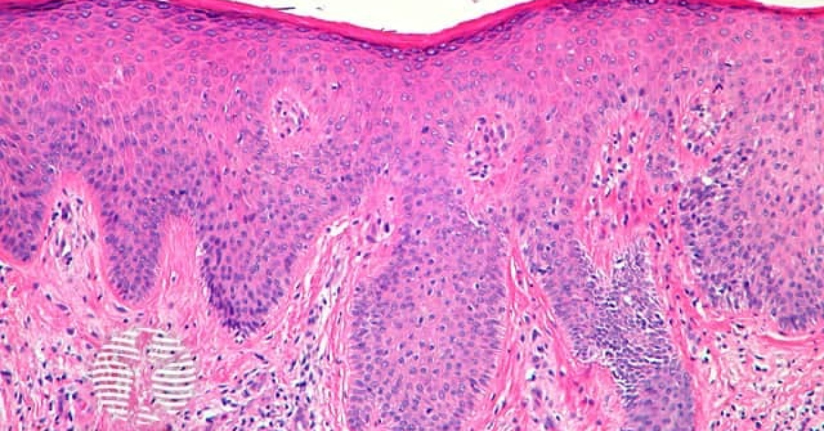 Chronic eczema pathology image