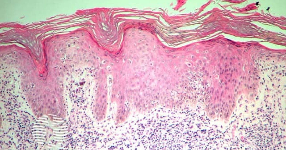 Chronic eczema pathology image