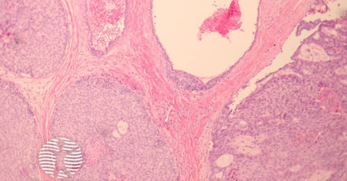 Endocrine mucin–producing sweat gland carcinoma pathology image