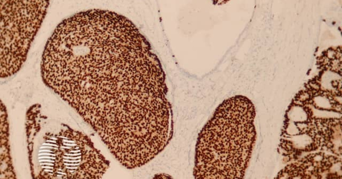 Endocrine mucin–producing sweat gland carcinoma pathology image