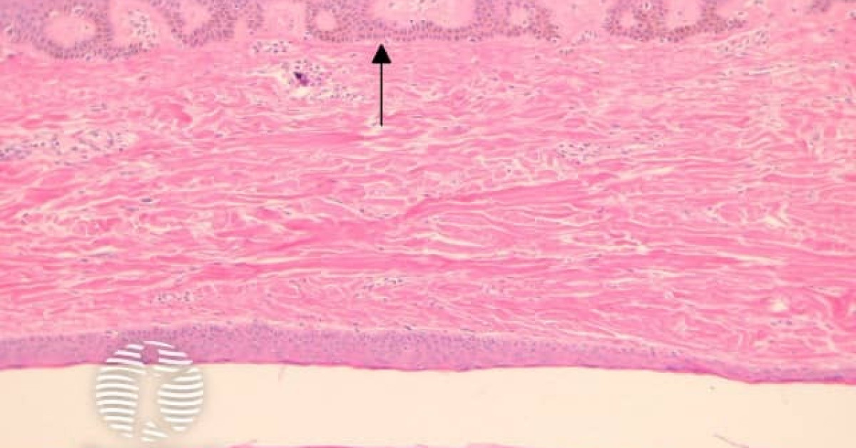 Epidermoid cyst pathology image