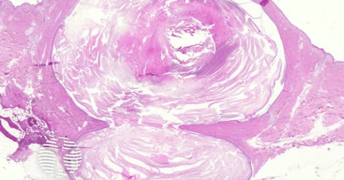 Epidermoid Cyst Pathology Image