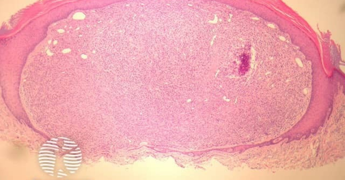 Epithelioid histiocytoma pathology image