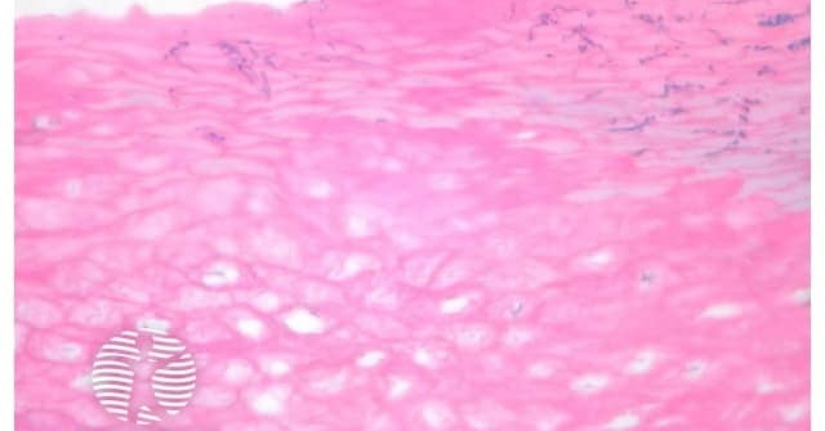 Erythrasma pathology image