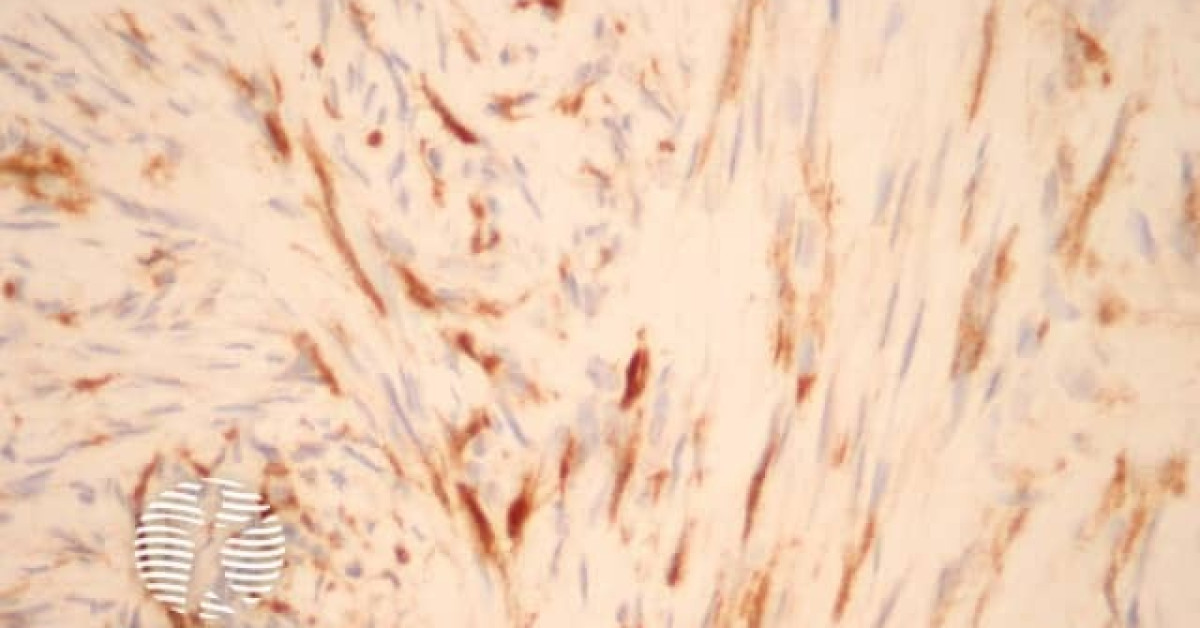 DermNet® - Factor 13a immunohistochemistry of dermatofibroma pathology ...