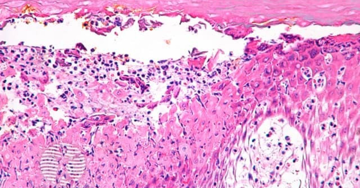 Farmyard pox pathology image