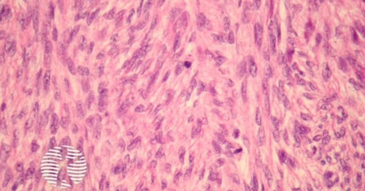 Fibrosarcoma pathology image