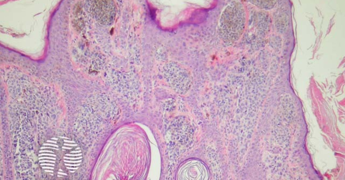 Melanocytic naevus pathology: compound naevus image