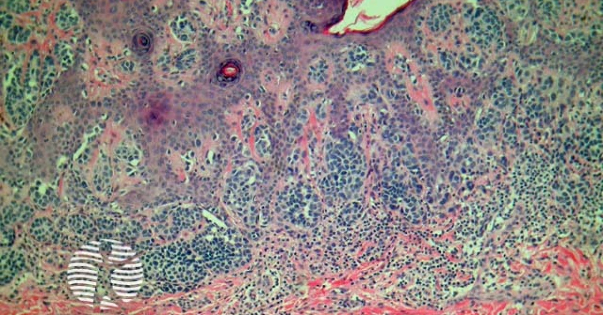 Melanocytic naevus pathology: compound naevus image
