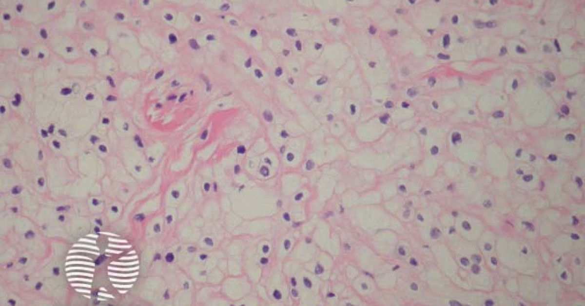 Melanocytic naevus pathology: balloon cell naevus image